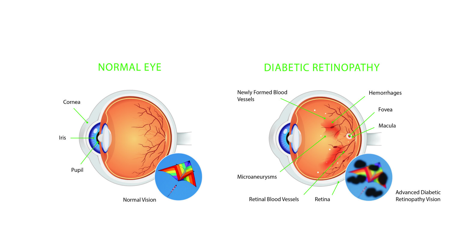 Diabetic Eye Exams • Latham Internal Medicine